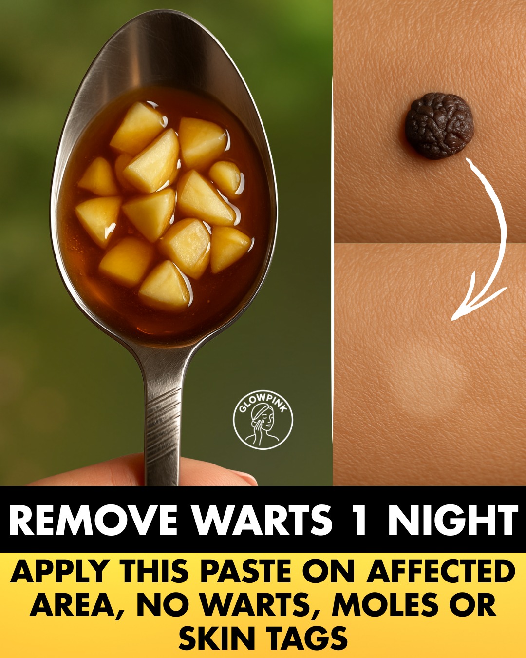 7 Natural Home Remedies To Remove Warts – hopemakers